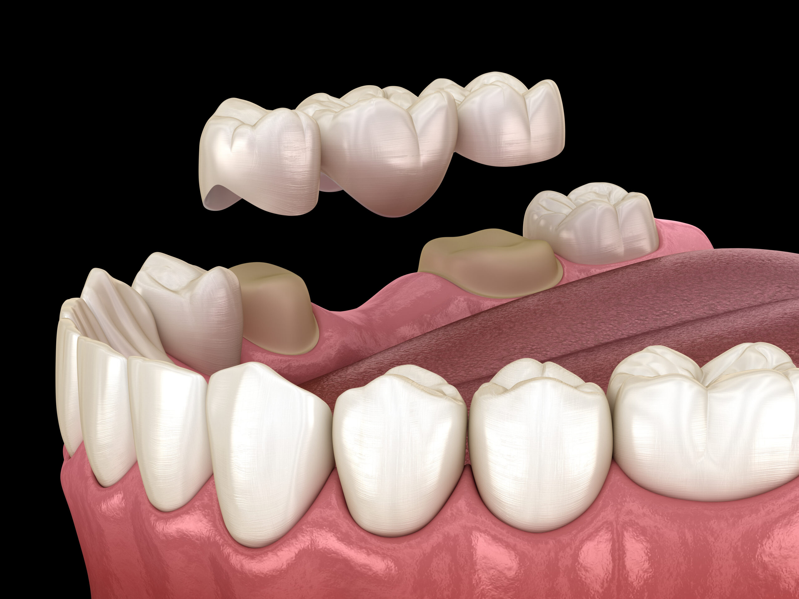 A Look At Lifelike Dental Bridges | Londonderry, NH